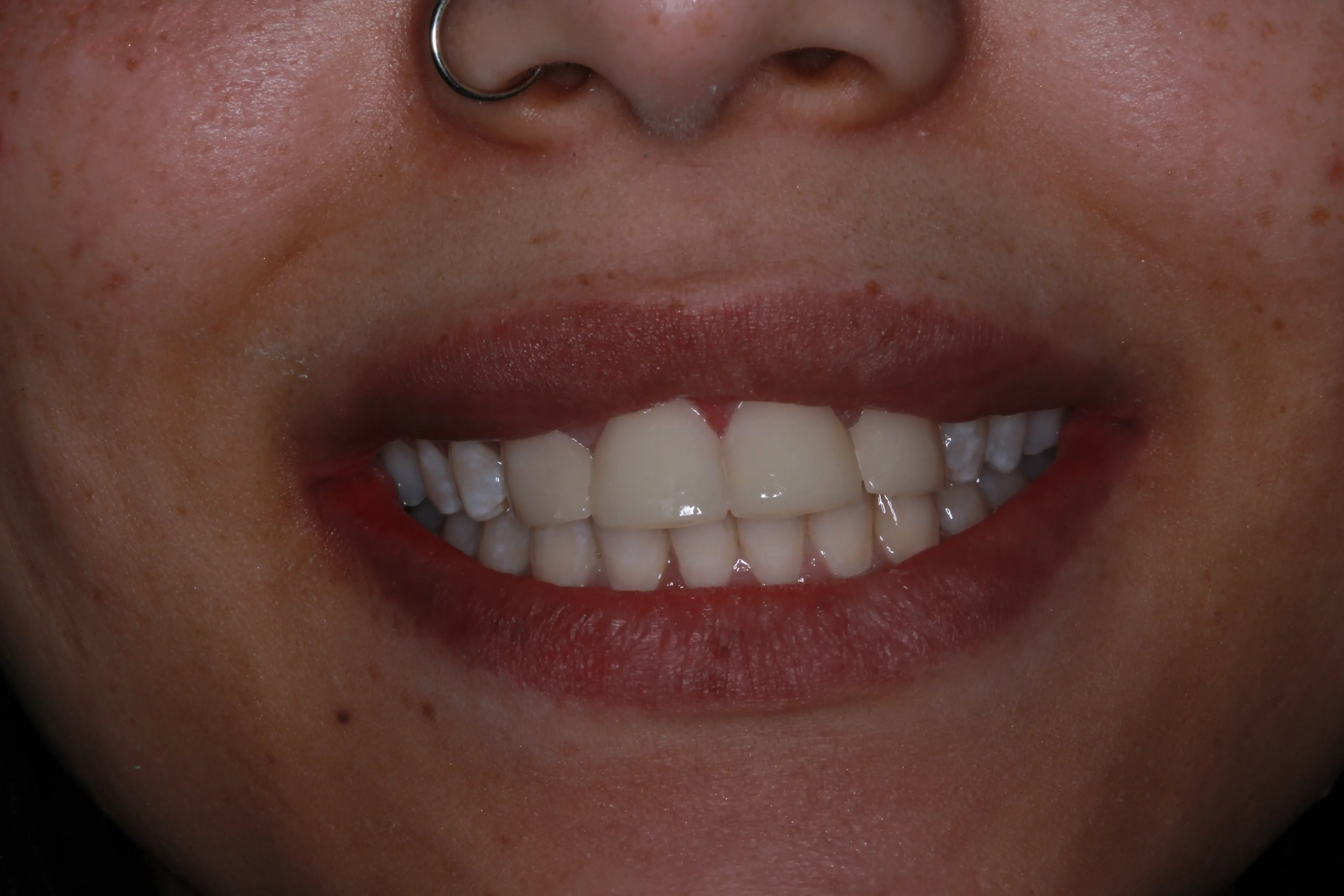 Successful composite bonding - Case Study | Stoke Dental